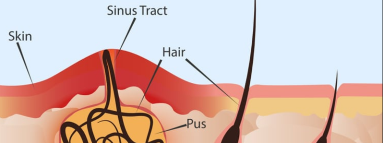 Different Types of Pilonidal Cyst Removal Surgery: Which One is Right ...